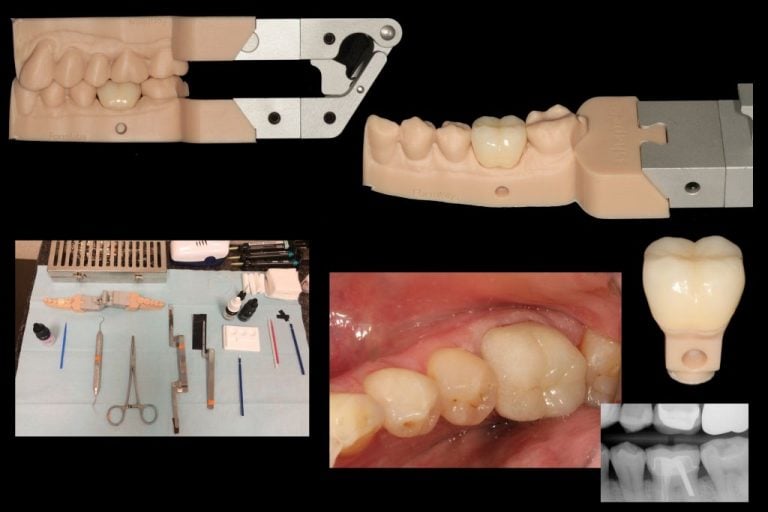 Working with Formlabs Dental Model Resin – Michael Scherer, DMD, MS